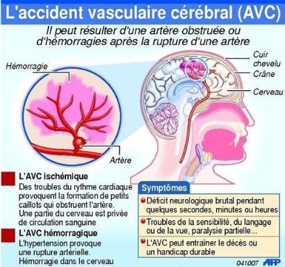 Les accidents cérébraux vasculaires (AVC) chez les seniors